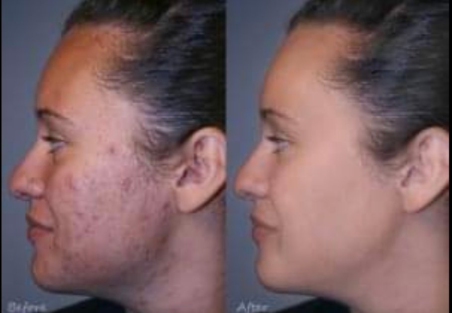 Meladerm Review: The Ultimate Solution for Even Skin Tone and Dark Spot ...